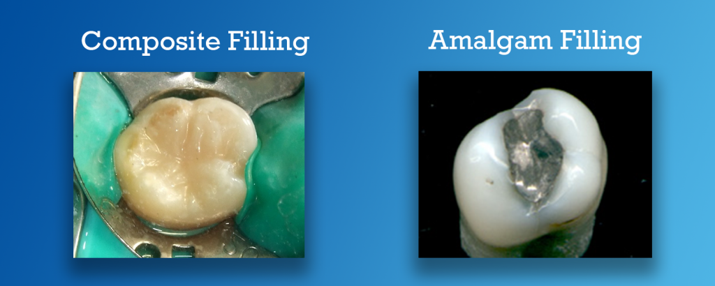Dental Filling Showdown: Amalgam vs Composite | CariFree