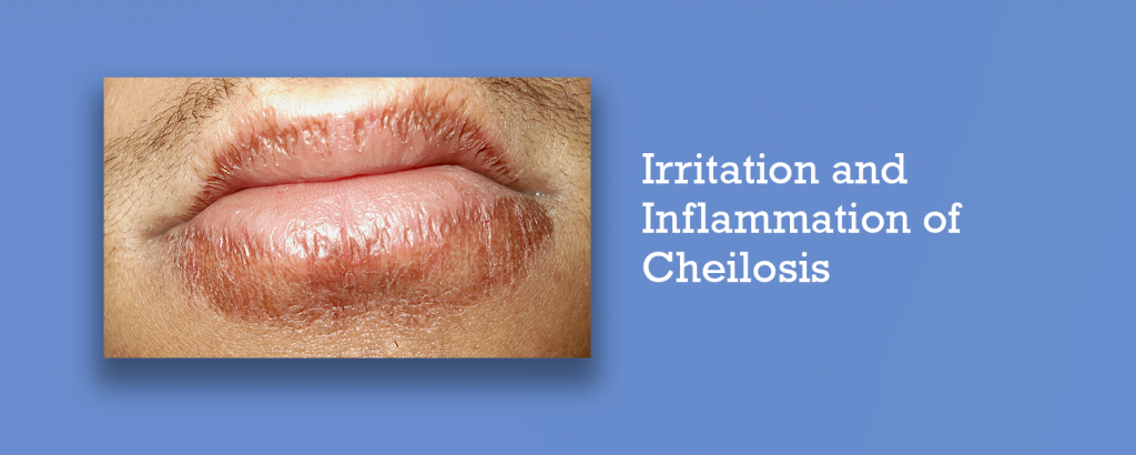 Cheilosis: Causes, Symptoms and Treatment | CariFree